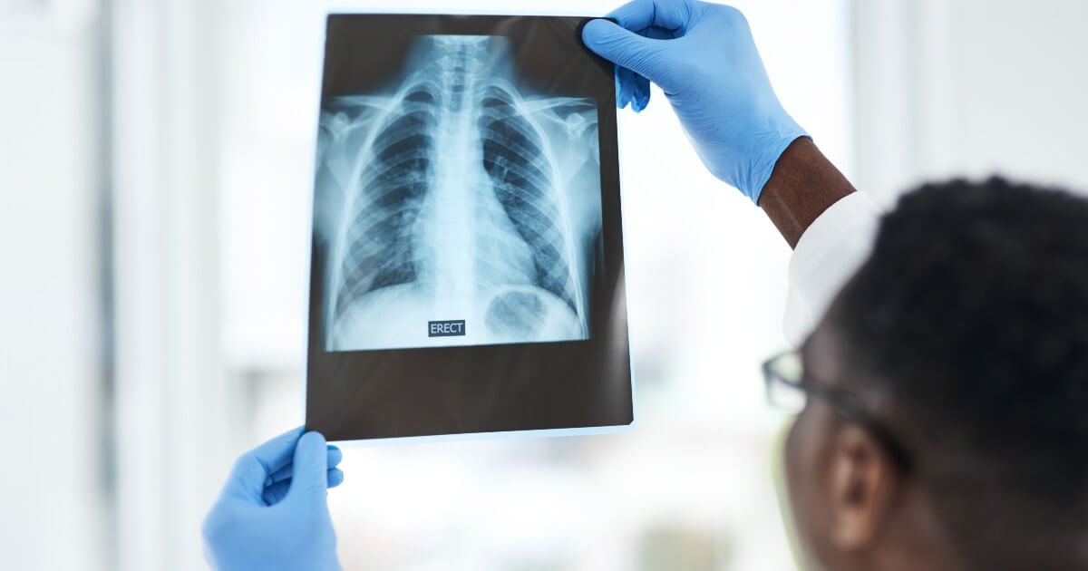 What to Do If You Have Broken Ribs From a Car Crash